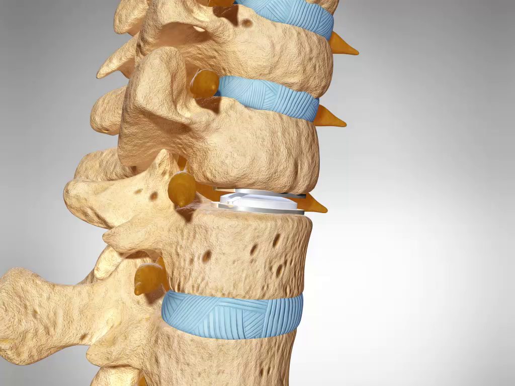 RasouliSpine | Spine Procedures | Dr. Alexandre Rasouli, M.D.