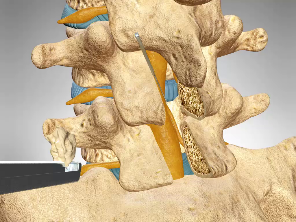 RasouliSpine | Spine Procedures | Dr. Alexandre Rasouli, M.D.
